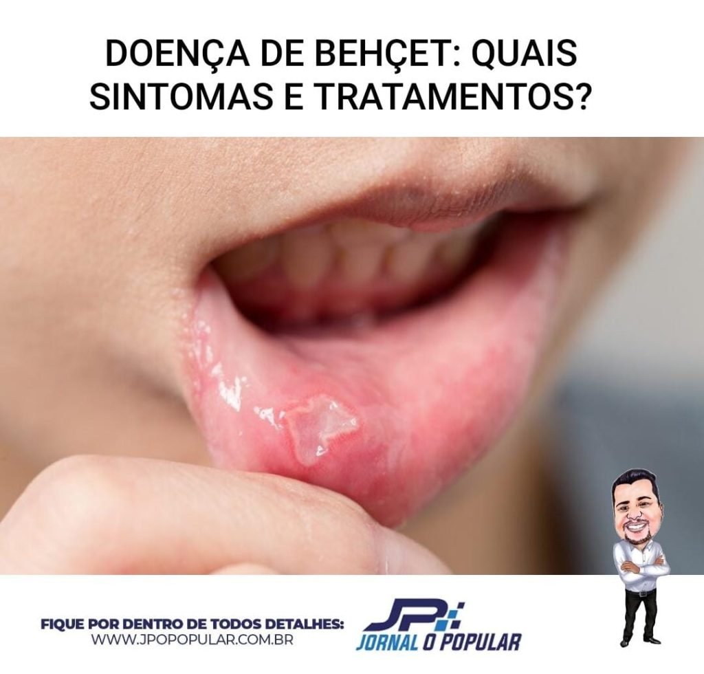 DOENÇA DE BEHÇET: QUAIS SINTOMAS E TRATAMENTOS? - JP Jornal O Popular